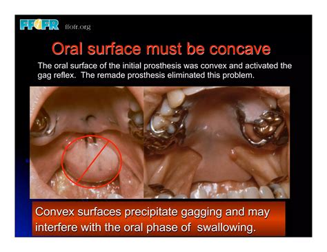 20 Newrestoration Of Soft Palate Defects Pdf