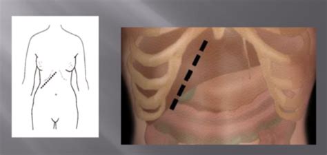 Surgical Incision Flashcards Quizlet