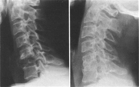 Aneurysmal Bone Cyst Spine