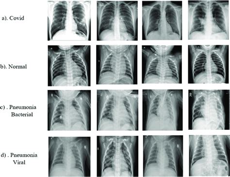 Chest X Ray Dataset Download Scientific Diagram