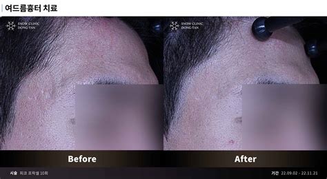 여드름 클리닉 동탄 스노우클리닉