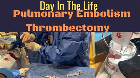 Interventional Radiology Day In The Life Episode 2 Pe Thrombectomy Youtube