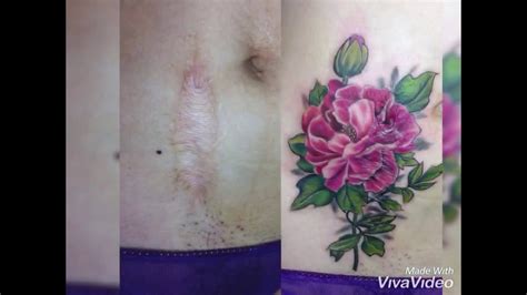 Hình Xăm Che Thẹo Mổ Đẹp Lấy Lại Tự Tin Cho Chị E Phụ Nữ Shop Nguyễn Tattoo Q PN