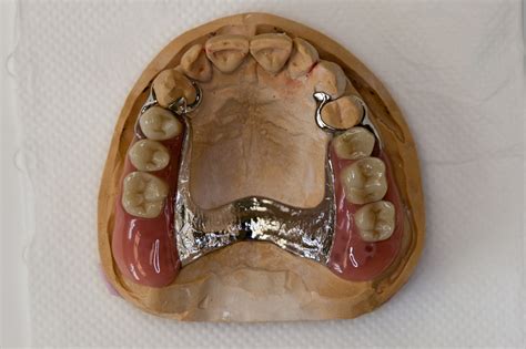 Dentures Seven Hills Dentist Capstone Dental