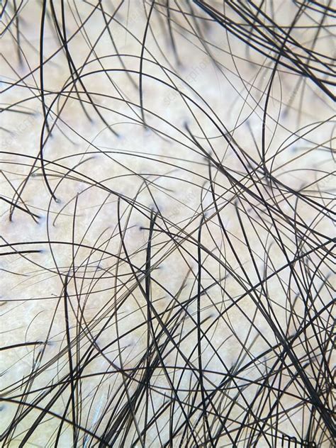 Female Pattern Hair Loss Dermoscopy Stock Image C0603912