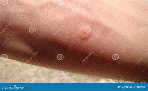 Bee Sting Allergy Kit At Freddie Johson Blog