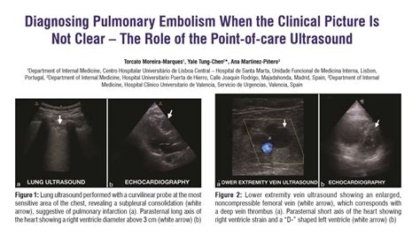 BÀi SoẠn VỀ SiÊu Âm ChẨn ĐoÁn Pocus For Unclear Pulmonary Embolism