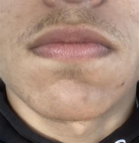 One Month Progress Rminoxidil