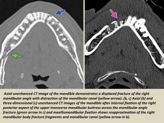 Presentation1 Radiological Imaging Of Fractures Pptx