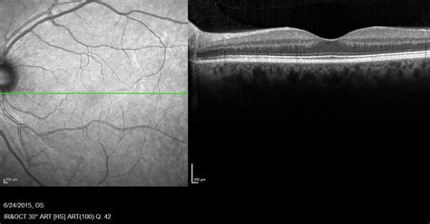 OCT Plays Key Role In Cataract Surgery Workup