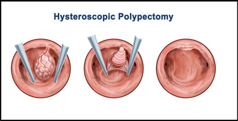 Hysteroscopy Polypectomy Fibroids Vs Polyps Treatment Symptoms