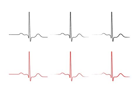 트리쿨러 리폴라라이제이션 Ventricular Repolarization 심장 주기 Ecg 정상적인 Sinus 리에서 심장의 Qt 간격 Qt Interval