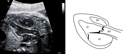 The Left Ventricular Outflow Tract View This View Shows The Left Download Scientific Diagram