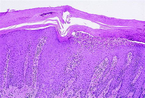 Parakeratosis Journal Of The American Academy Of Dermatology