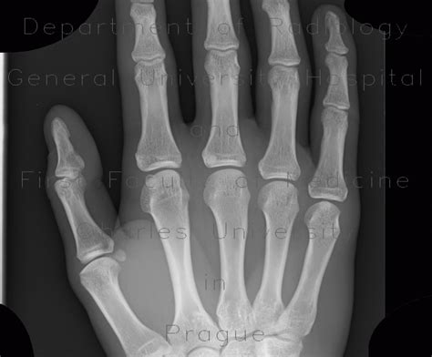 Radiology Case Bone Island Metacarpal Bone