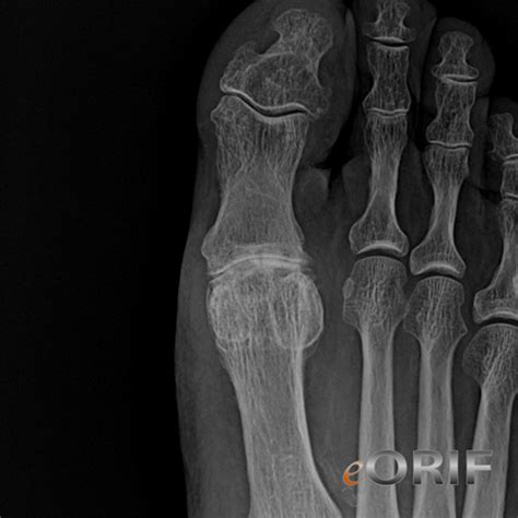 Hallux Rigidus M2020 7352 Eorif