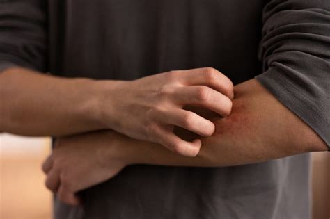 Should You Scratch That Itch Science Has A Surprising Answer