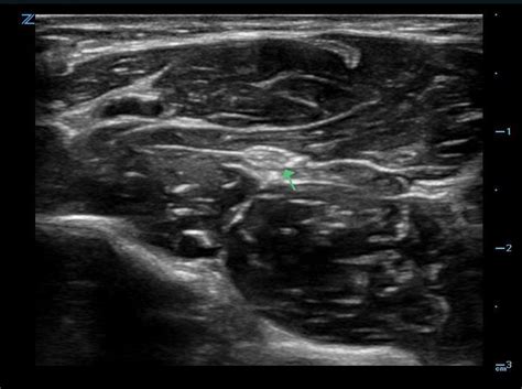 Median Nerve Block Sonoguide