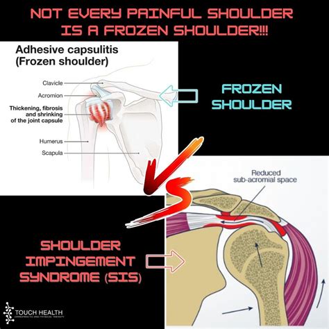 Frozen Shoulder Adhesive Capsulitis