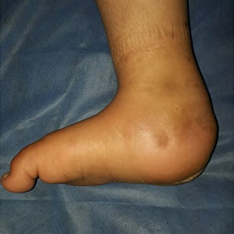 Calcaneus Deformity Is Noticed Download Scientific Diagram