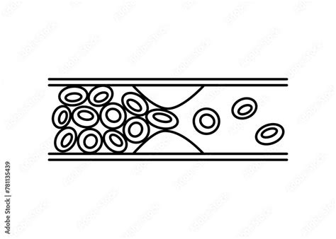 Deep Vein Thrombosis Dvt Artery And Vein Disease With Fat Cells Line