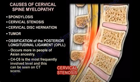 Cervical Spine Myelopathy