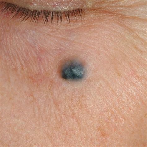Cellular Blue Nevus