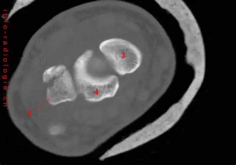 Ct Scan Of The Wrist W Radiology