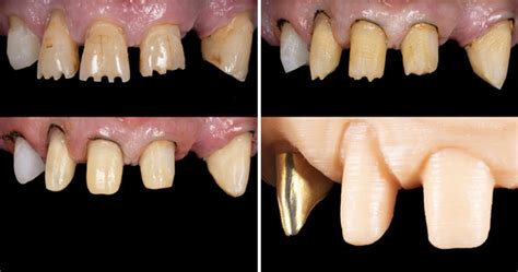 La Prothèse Composite à Lère Du Numérique Dr Billon Et Axel Guego