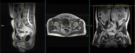 Mri Prostate Protocols Mri Prostate Cancer Multiparametric Planning