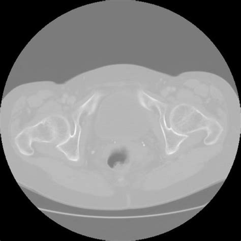 Liver Detector Object Detection Dataset V1 2022 12 25 3 14pm By