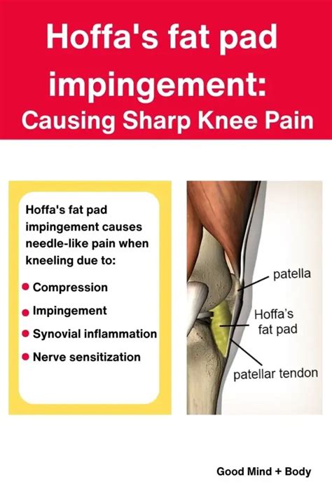 10 Reasons For Sharp Pain In The Knee When Kneeling Good Mind And Body