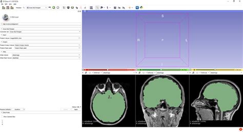 How I Create A 3d Model Of My Brain Using Slicer And The Swiss Skull