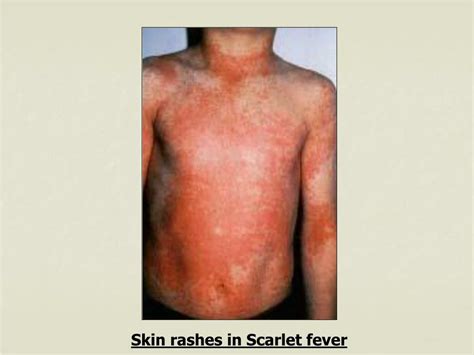 Ppt Streptococcus Powerpoint Presentation Free Download Id5596913