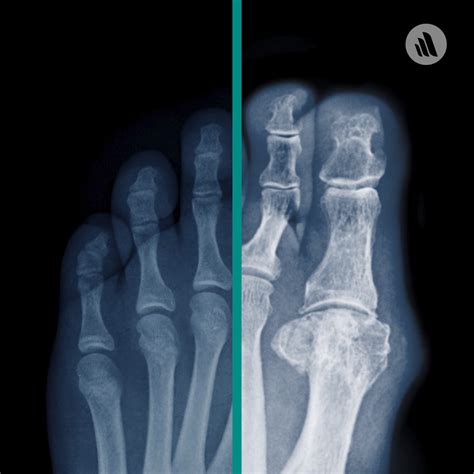 Gout Musculoskeletal And Connective Tissue Disorders Artofit