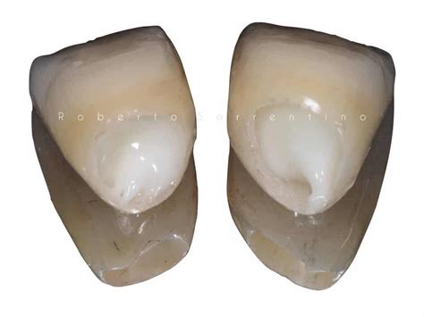 Zirconia Crowns Cementation With Resin Modified Glass Ionomer Cement Myzerodonto