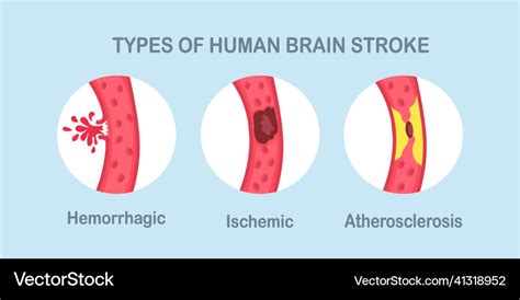 Types Of Human Brain Stroke Ischemic Royalty Free Vector
