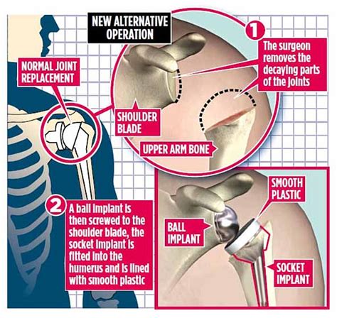 Shoulder Socket Break At Qiana Flowers Blog