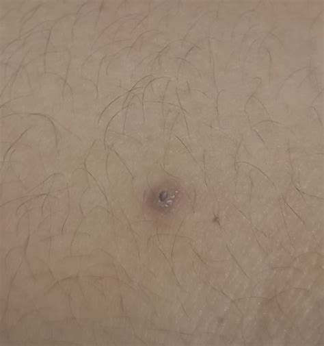 팔에 이상한 검은 뾰루지 지식in