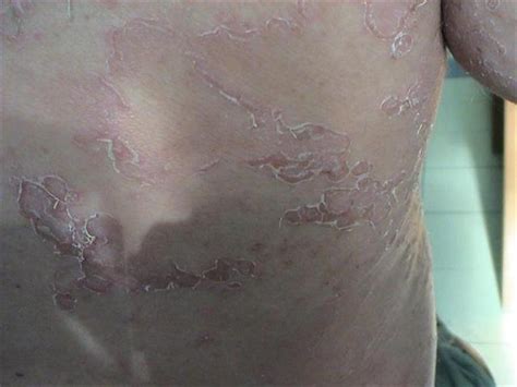 Genodermatoses Netherton Syndrome Picture Hellenic Dermatological Atlas Over 2700