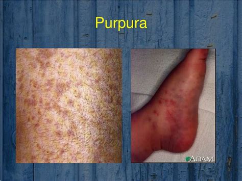Ppt Vascular Purpuras Powerpoint Presentation Free Download Id2239367
