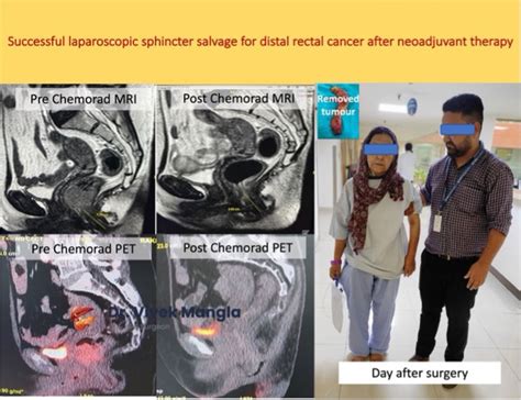 Intersphincteric Resection A Technique To Restore Normal Passage For