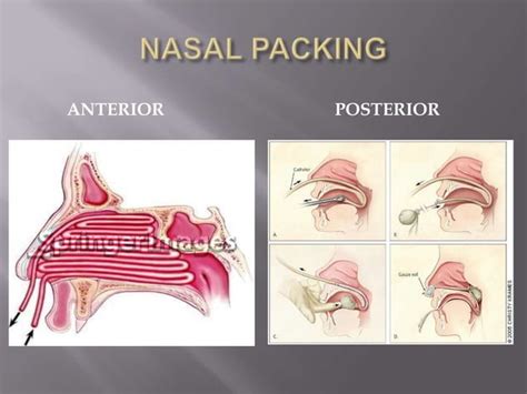 Management Of Epistaxis Pptx