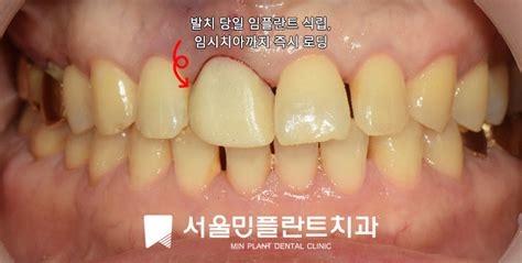 태평동치과 앞니 임플란트 발치 당일 임시치아까지 네이버 블로그