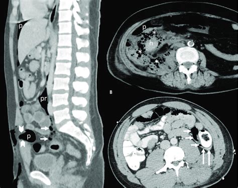 Extraluminal Air And Bowel Contents In Full Thickness Bowel Tears A Download Scientific