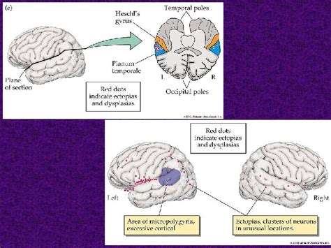 Brain Lateralization Language And Cognition Cerebral Lateralization U