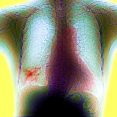Lung Cancer X Ray Photograph By Du Cane Medical Imaging Ltd Fine Art America