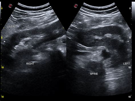 Fused Crossed Renal Ectopia At April Langdon Blog
