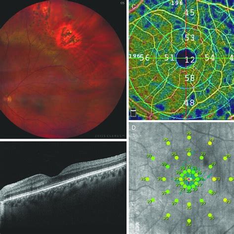 The Case Of A 52 Year Old Female Patient After Scleral Buckling Surgery