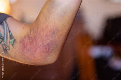 Intense Bruising From A Dislocated Elbow Joint And Ligament Damage On